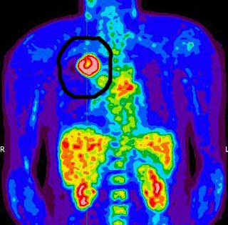 Manse Medical: PET scanning, in lung cancer and in Ballarat